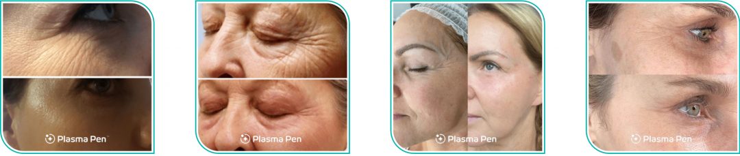 Plasma Pen | Dermacure Clinic