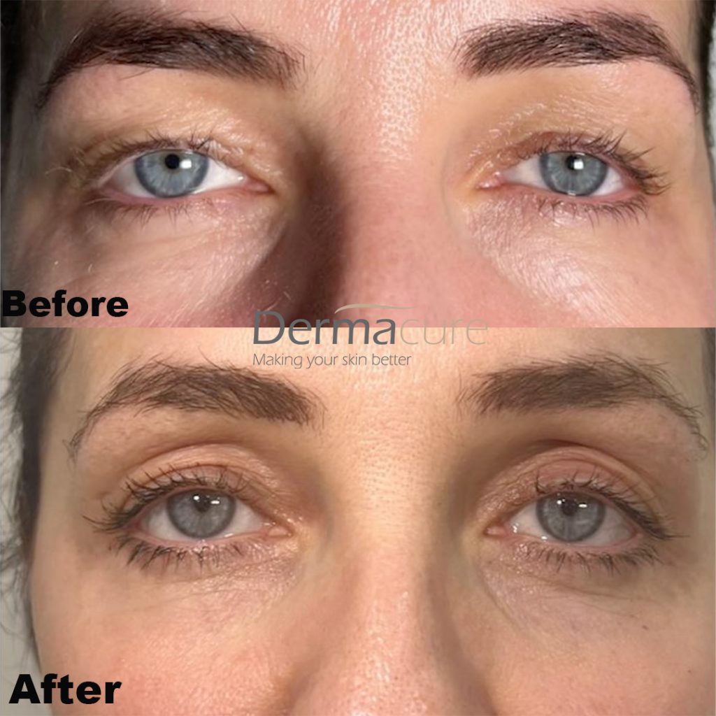 Plasma Pen | Dermacure Clinic